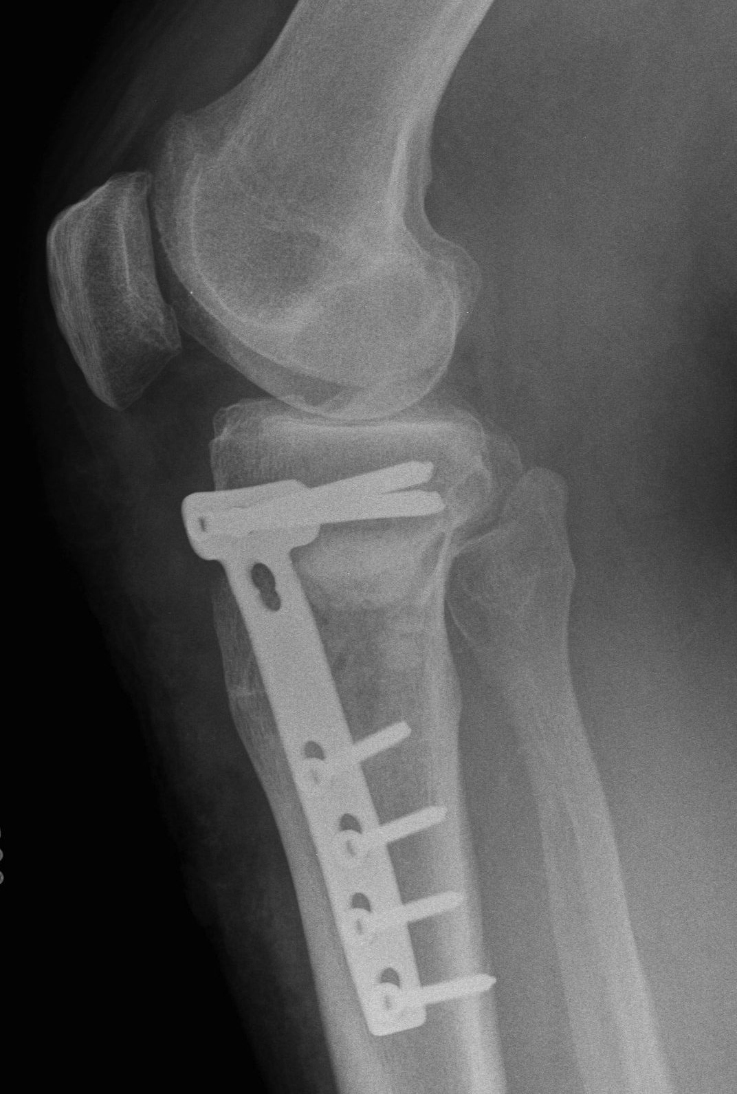 opening wedge | The Bone School